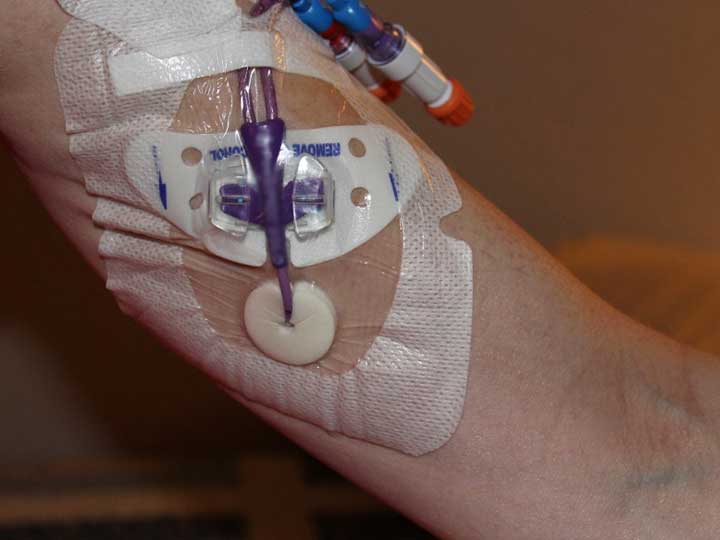 ICYMI: Best Practices for PICC insertion, care and management ...