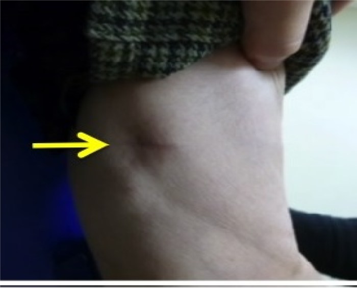 The lady on the plane with an upper arm port. | Infusion Nurse Blog